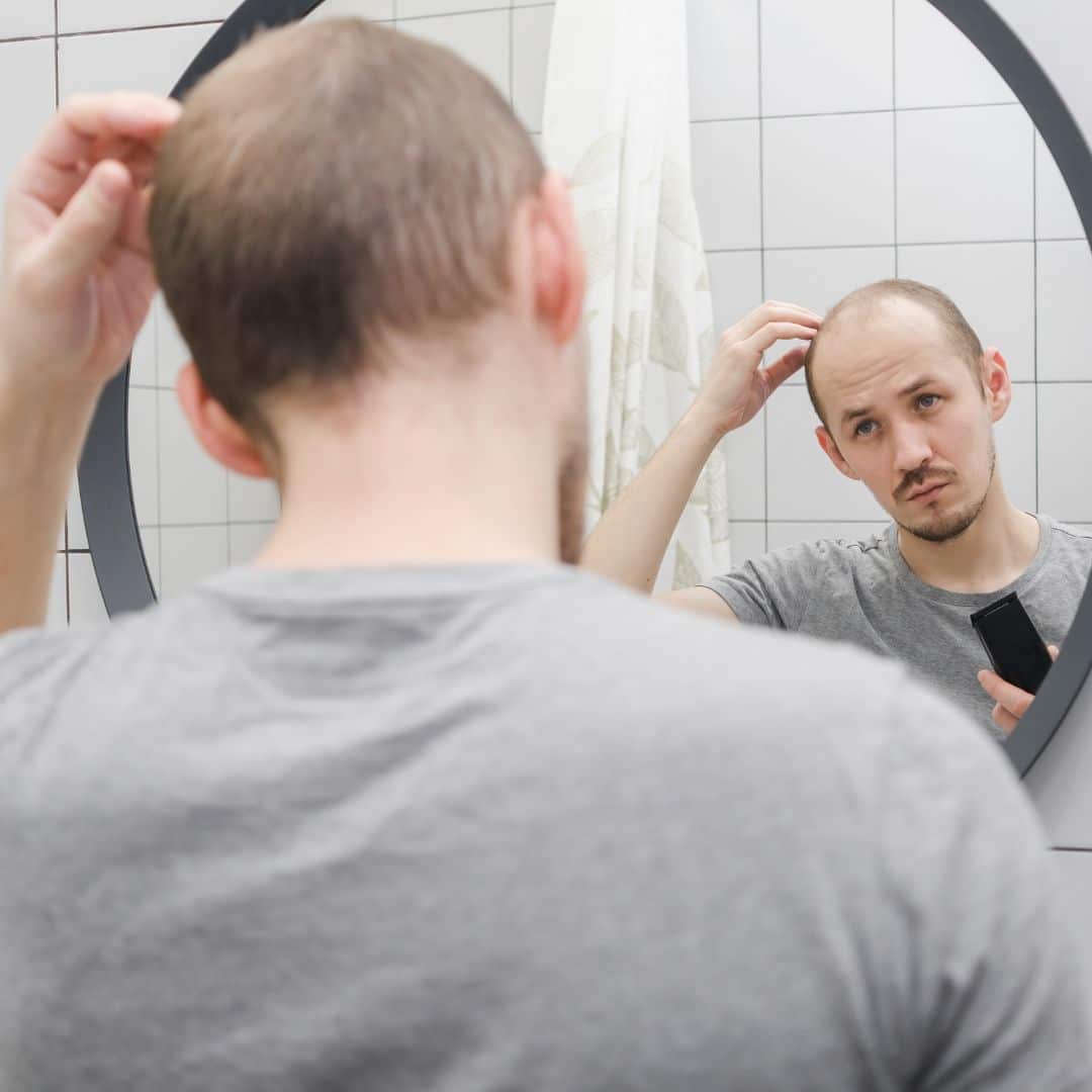 Descifrando la Alopecia Androgenética Masculina: Causas, Síntomas y ...