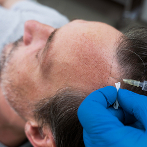 Mesoterapia Capilar: ¿De qué se trata? - Capil Clinic